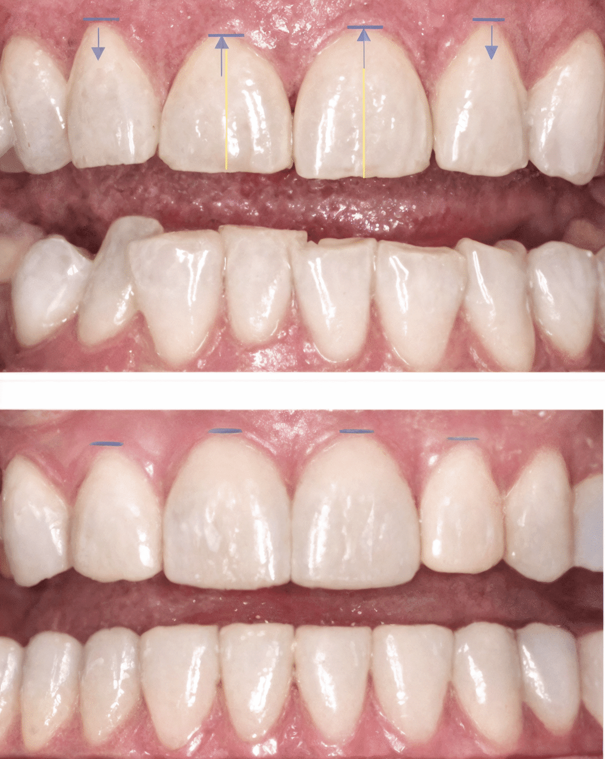 Teeth Reshaping Shelby Township | Fredal Orthodontics